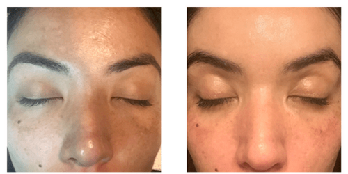 The Perfect Derma Peel - Chesapeake Laser and Skin Care Center