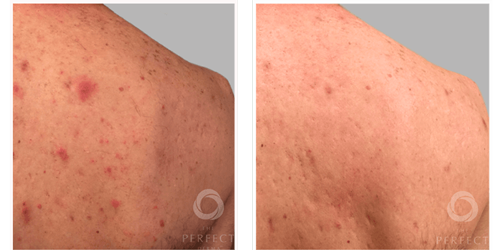 The Perfect Derma Peel - Chesapeake Laser and Skin Care Center