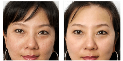The Perfect Derma Peel - Chesapeake Laser and Skin Care Center