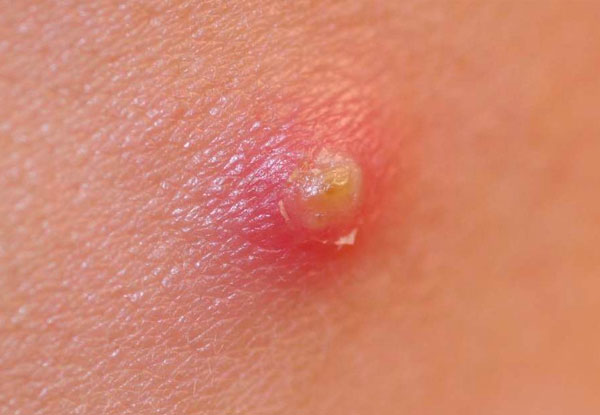 Acne Treatment Annapolis & Queen Anne's County | Chesapeake