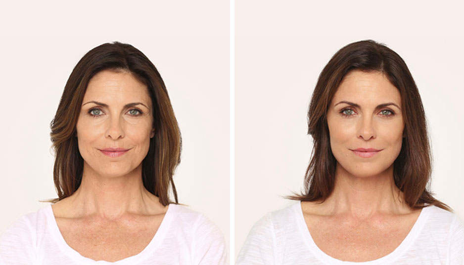 Radiesse - Chesapeake Laser and Skin Care Center